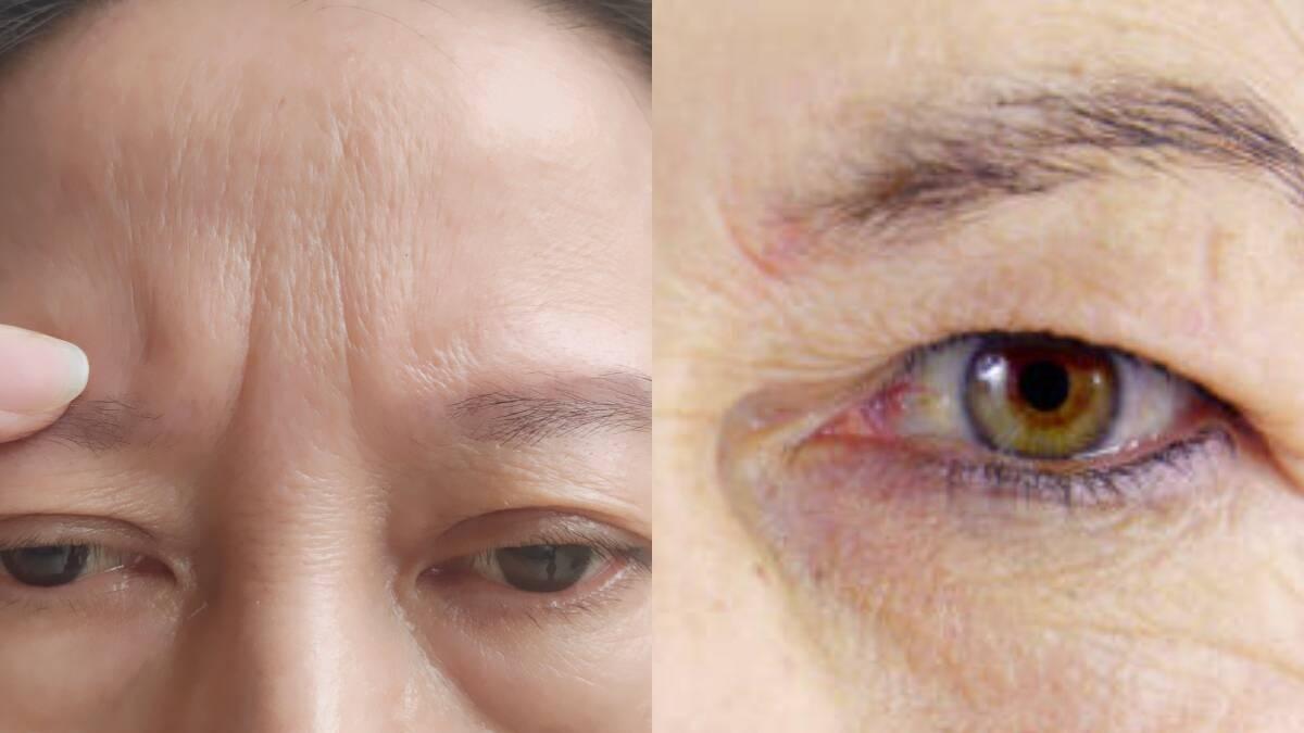 ¿Por qué se produce la celulitis en el ojo?