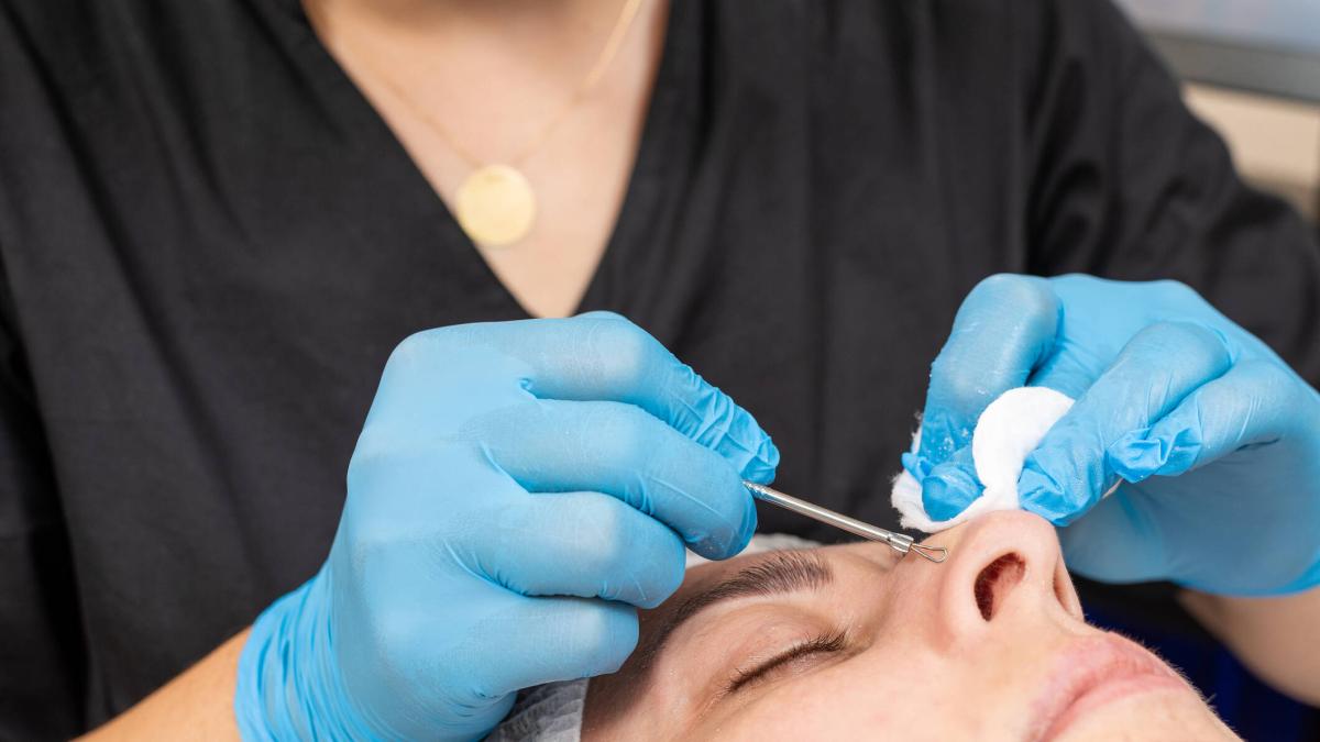 Acné quístico: factores que agravan esta condición cutánea