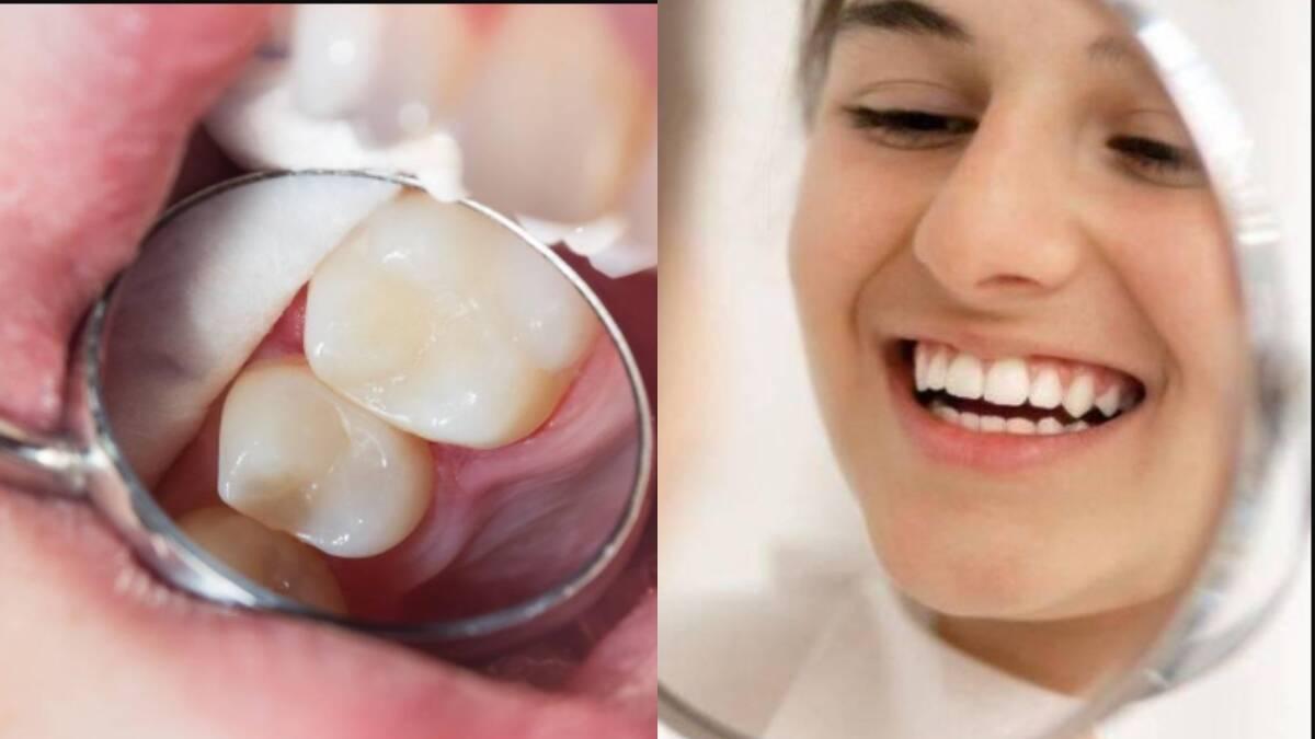 Cálculos dentales: el remedio casero que puede limpiar el sarro de sus ...