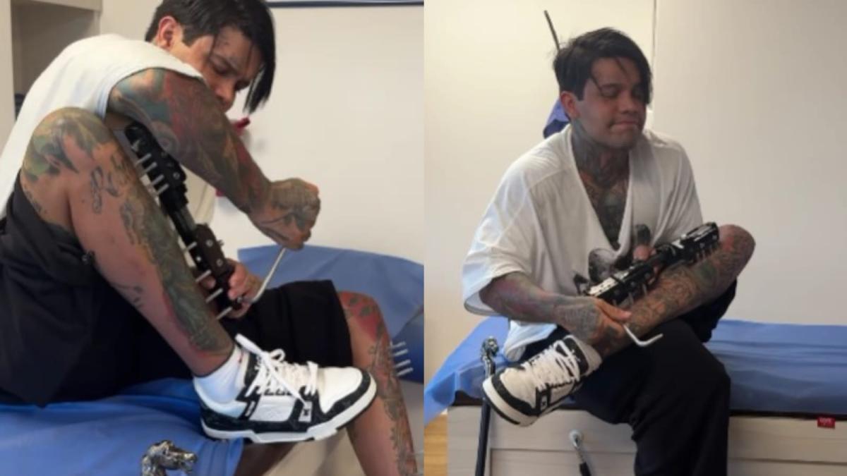 Video: Yeferson Cossio mostró cómo quedaron sus piernas tras cirugía de ...