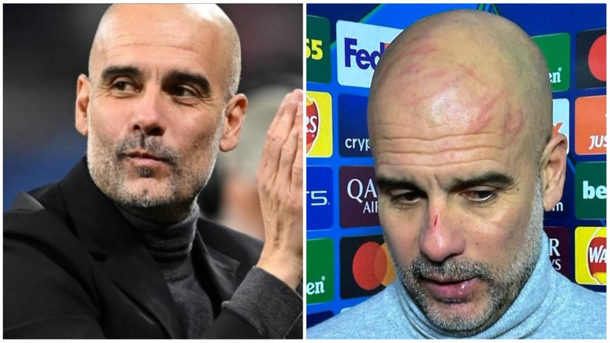Pep Guardiola apareció con su cara rasguñada tras empate de City ...