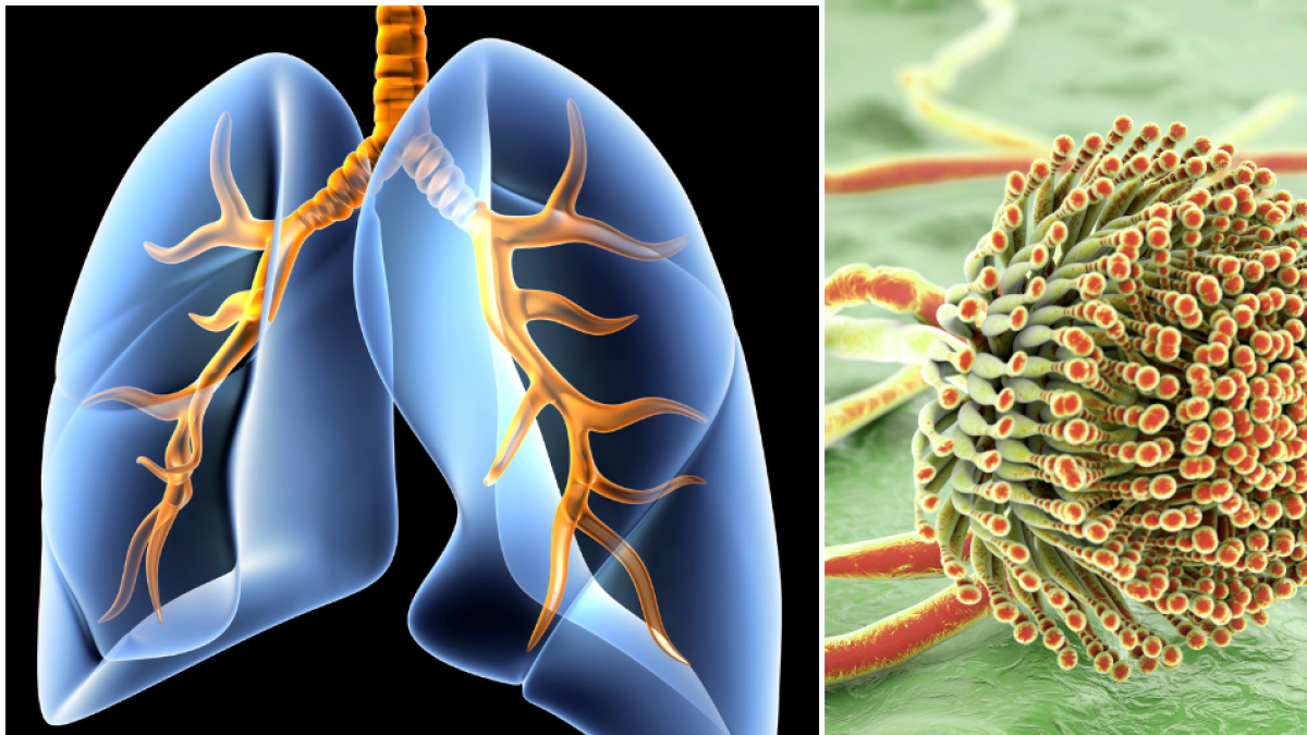 Tres síntomas de la aspergilosis, la infección pulmonar causada por un hongo en plantas y ...