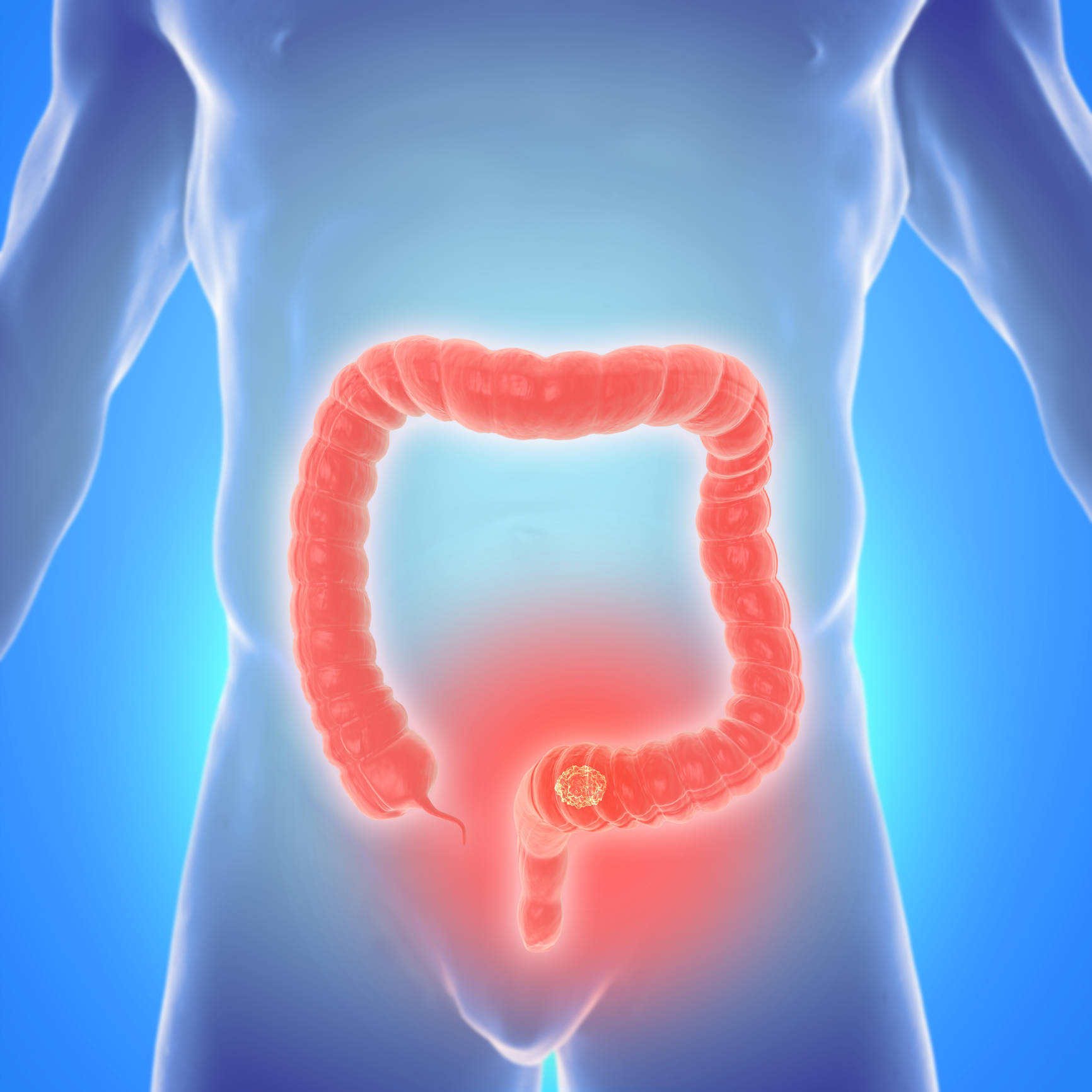 Colon irritable: alimentos que sirven para desinflamarlo