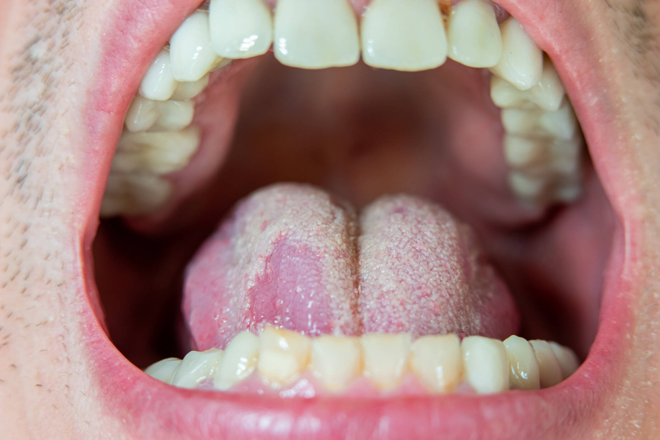 ¿De qué color debe ser la lengua? Esto dice Harvard sobre señales de ...