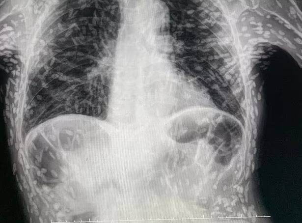 Radiografía muestra a hombre lleno de tenias por todo su cuerpo en Brasil