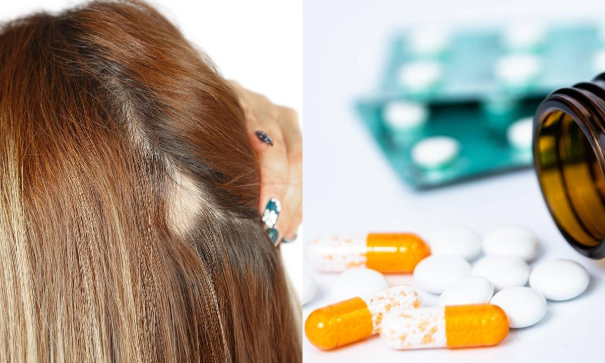 Las causas de la calvicie en hombres y mujeres: ¿qué pueda hacer para ...