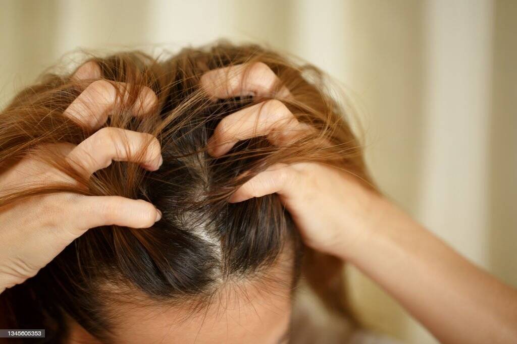 Remedios caseros para combatir los hongos que crecen en la cabeza
