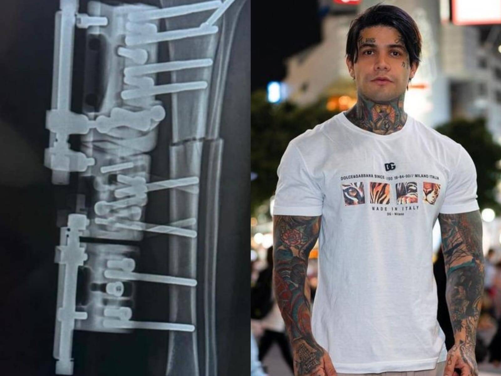 Yeferson Cossio se sometió a dolorosa cirugía de alargamiento: ¿qué se ...