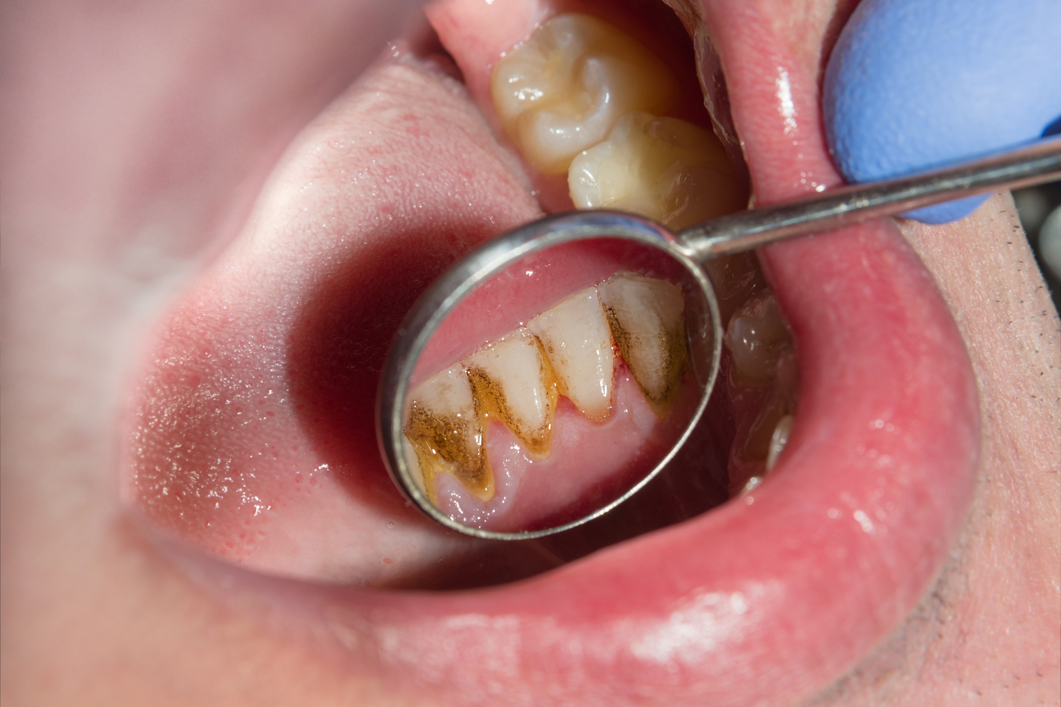 El truco casero para evitar el sarro en los dientes, según expertos