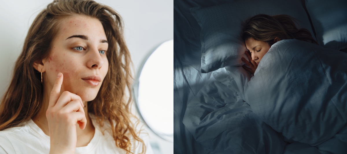 ¿Qué significa soñar con barros y acné en la cara? Expertos advierten ...