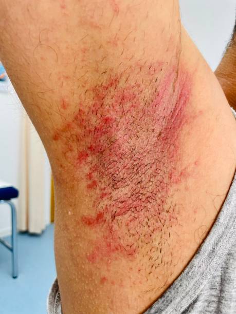 'Me salió un bulto en la axila': causas y cuándo ir al médico según los ...