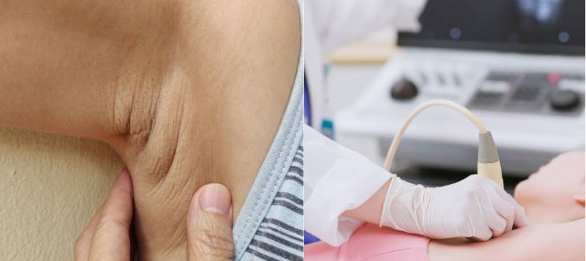 'Me salió un bulto en la axila': causas y cuándo ir al médico según los ...