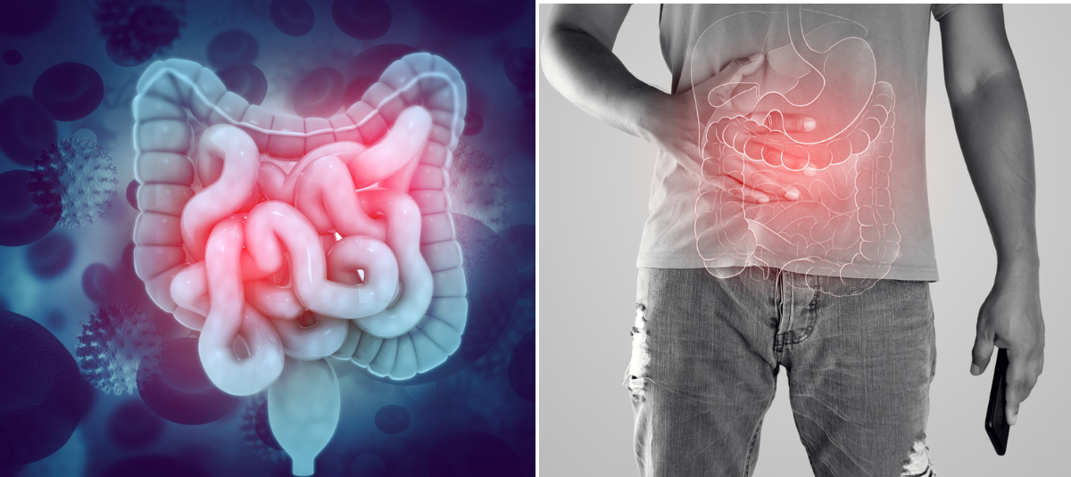 ¿Cómo saber si tiene el colon obstruido? Algunos síntomas que podrían ...